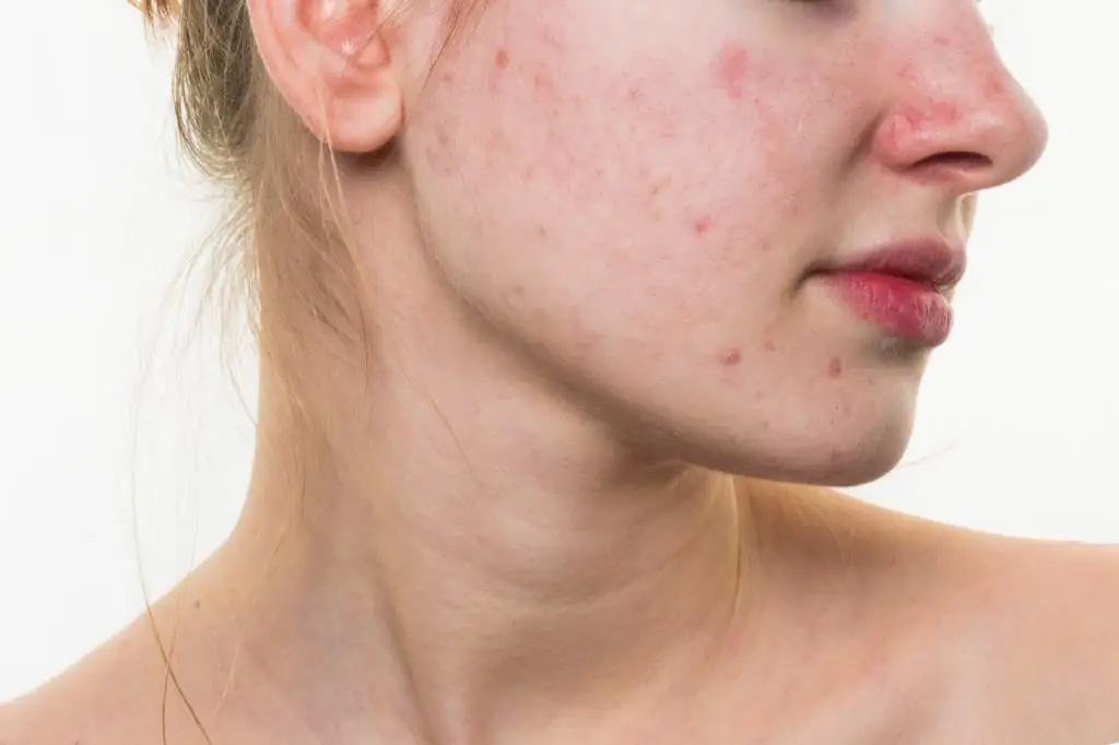 Spots On The Face Causes And Treatment Health 2023